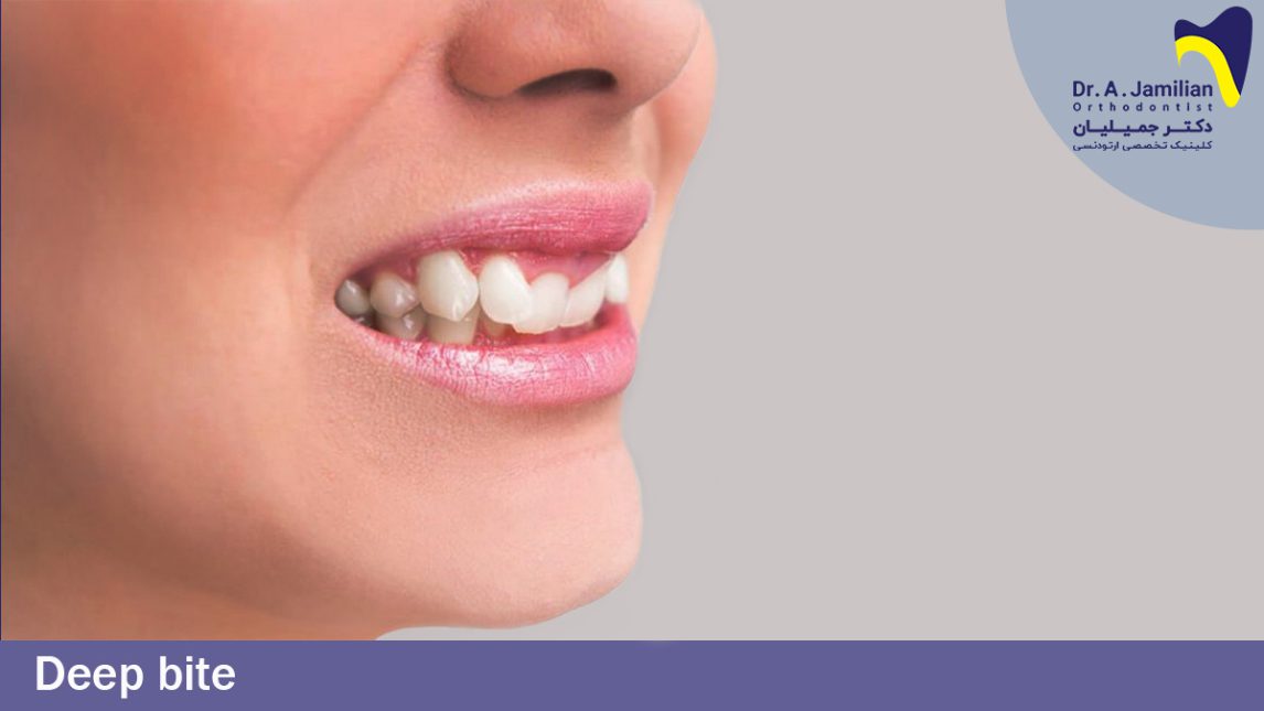 Deep Bite - Dr Jamilian - deep bite side effects