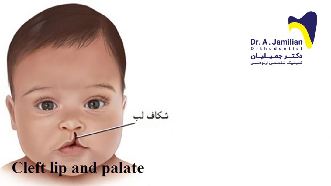 Cleft Lip and Palate - Dr Jamilian