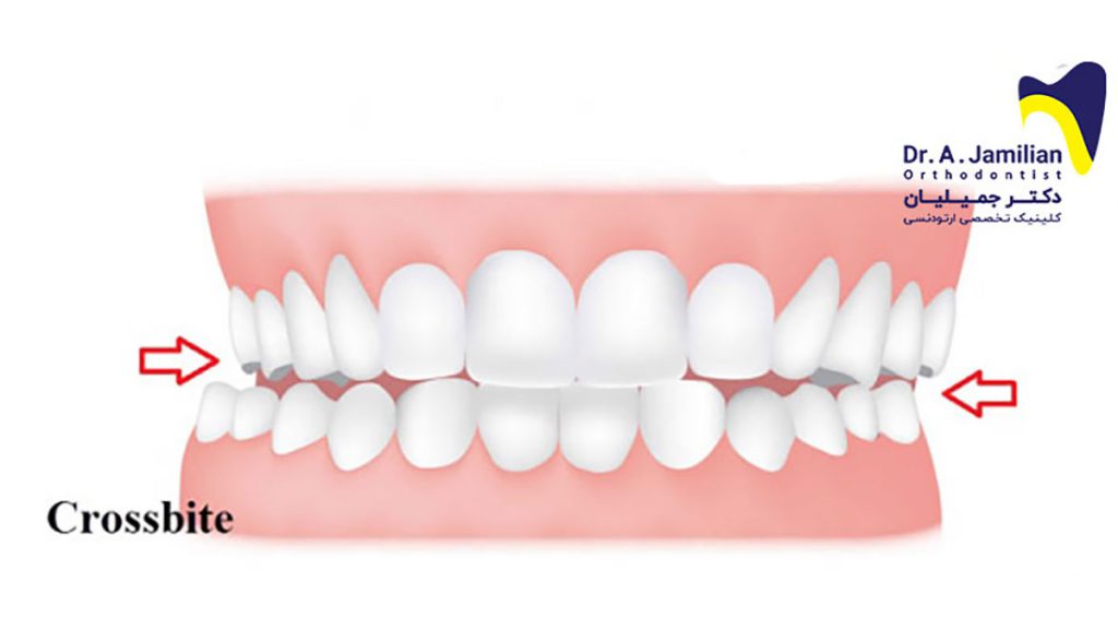 Anterior Cross Bite - Dr Jamilian