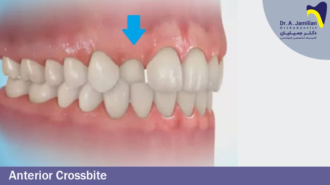 Anterior Crossbite - Dr Jamilian