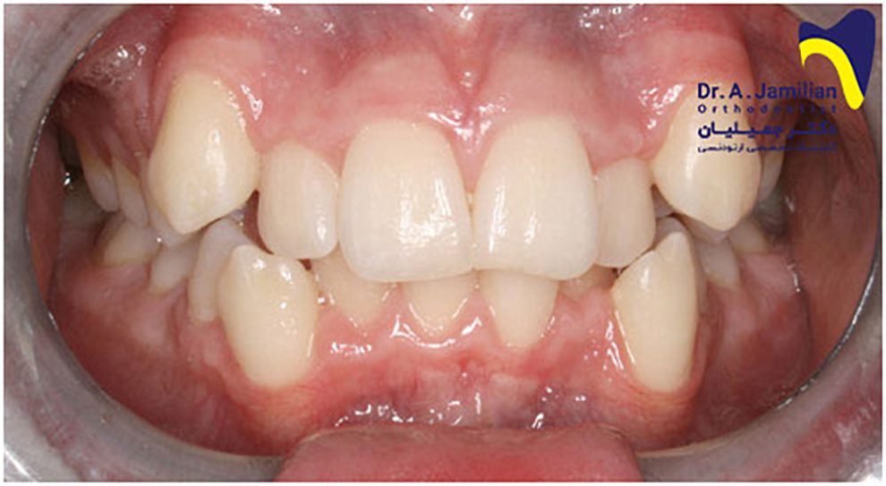 Tooth Crowding - Dr Jamilian