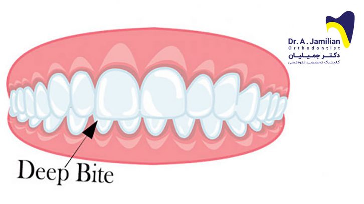 Deep Bite - Dr Jamilian - deep bite side effects