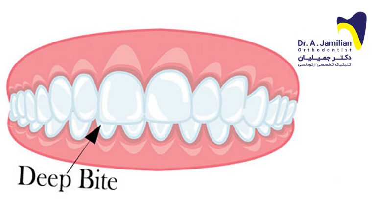 Deep Bite - Dr Jamilian - deep bite side effects