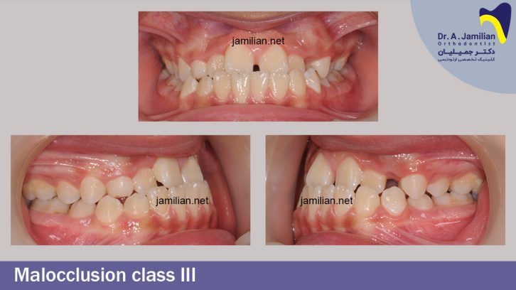 Class III skeletal malocclusion - Dr Jamilian