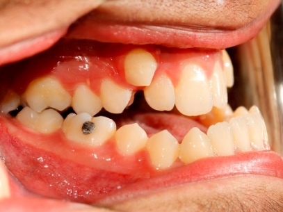 Mandible Prognathism - Dr jamilian Orthodontist