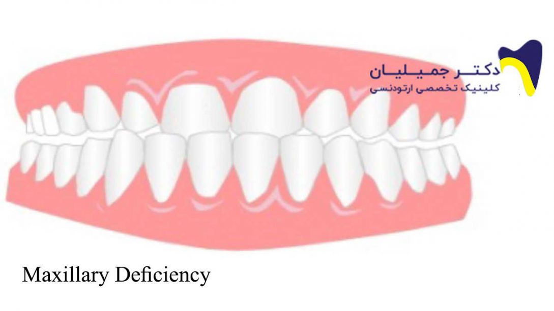Maxillary deficiency - Dr Jamilian