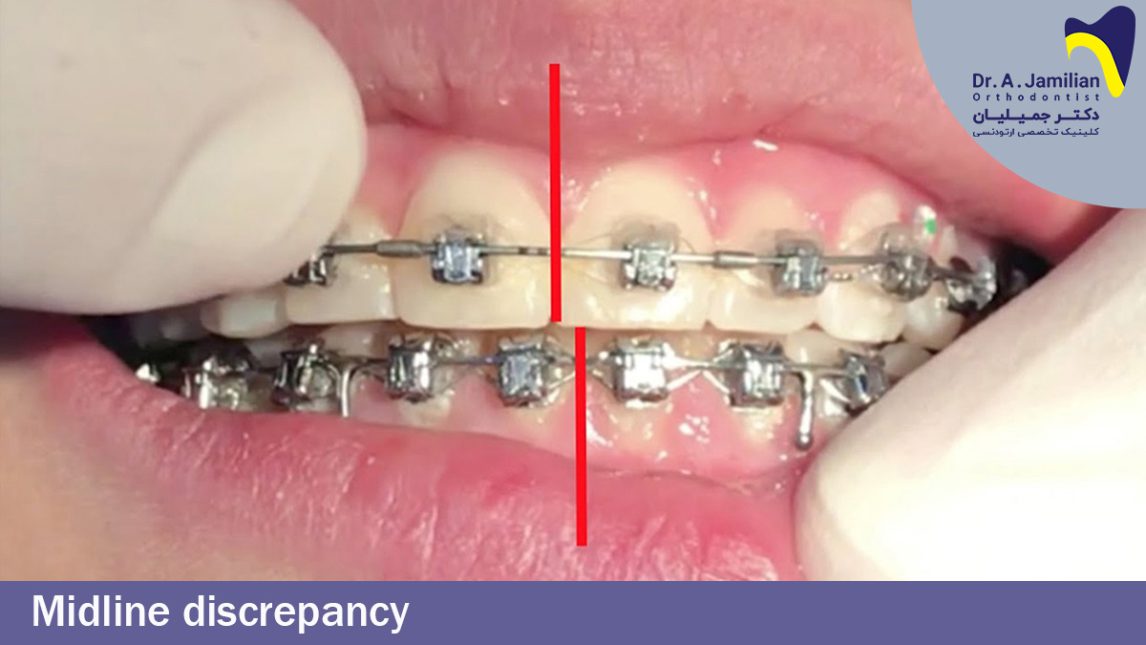 Midline discrepancy - Dr Jamilian