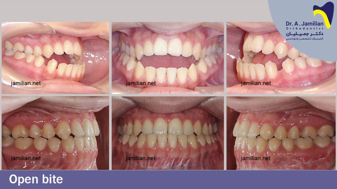 Open Bite - Dr Jamilian