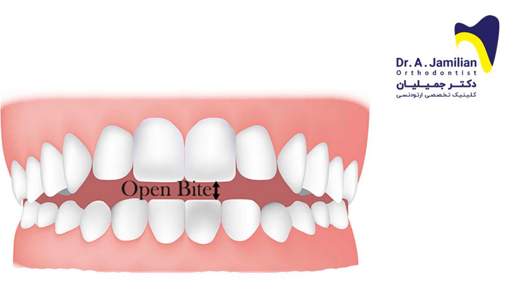 Offener Biss - Dr Jamilian