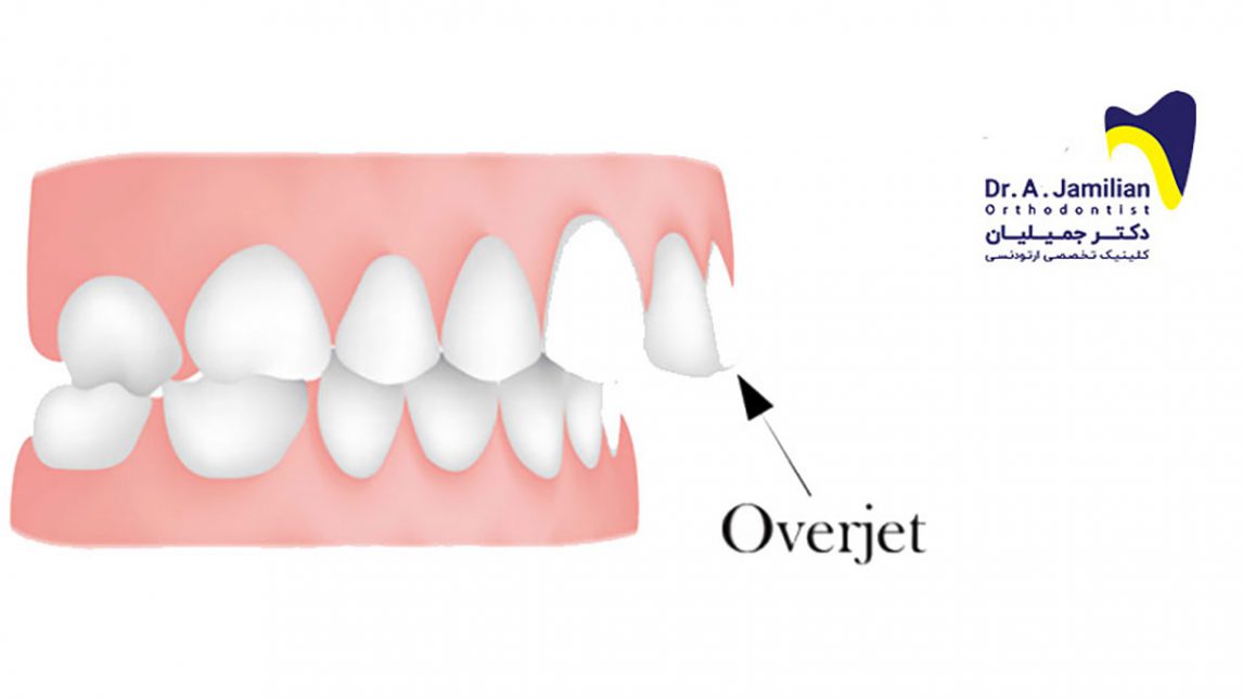 Overjet - Dr jamilian