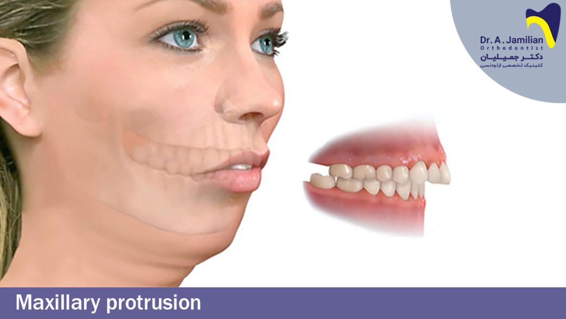 Maxillary protrusion - Dr Jamilian