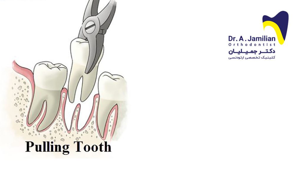 Tooth extraction in orthodontics - Dr Jamilian