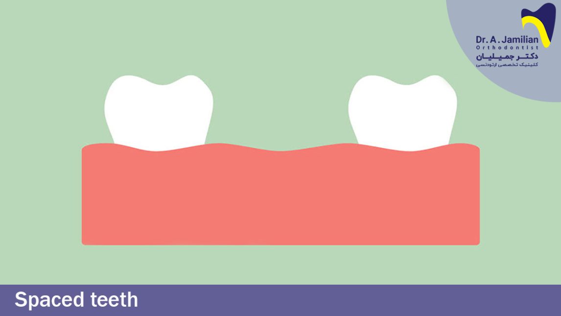 Spaced teeth - Dr Jamilian