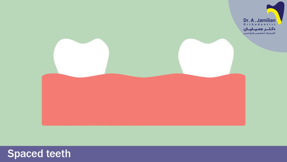 Spaced teeth - Dr Jamilian