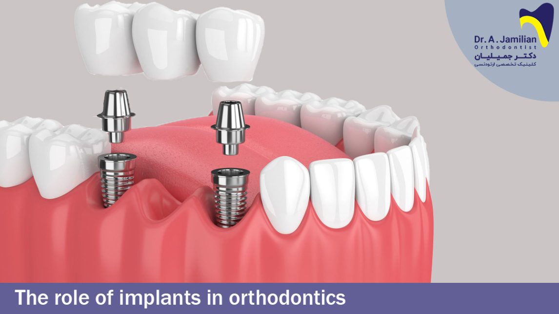 The role of implants in orthodontics - Dr Jamilian