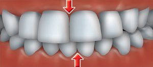 Midline discrepancy - Dr Jamilian