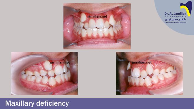 Maxillary deficiency - Dr Jamilian