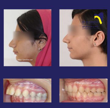 Before and After Images of Orthodontics pre post- Dr Jamilian