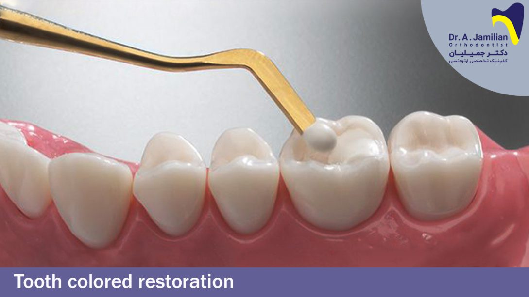 Tooth Colored Restoration - Dr Jamilian