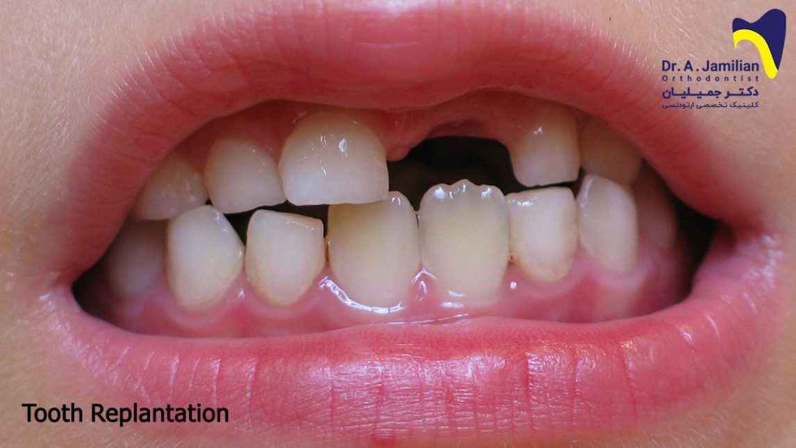 Tooth Replantation - Dr Jamilian