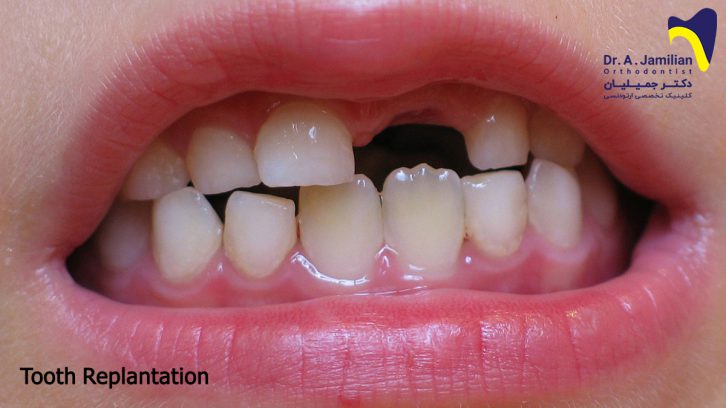 Tooth Replantation - Dr Jamilian