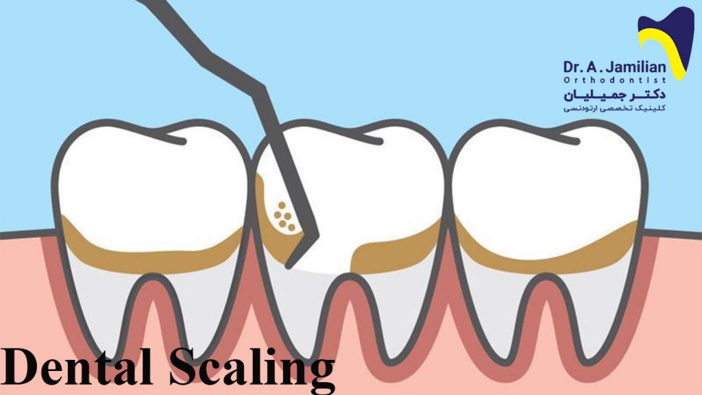 Dental Scaling - Dr Jamilian