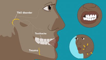 Unilateral Chewing Food - Dr Jamilian
