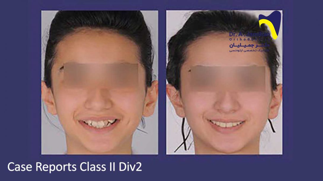 Case Reports-Class II Div 2 - Dr Jamilian