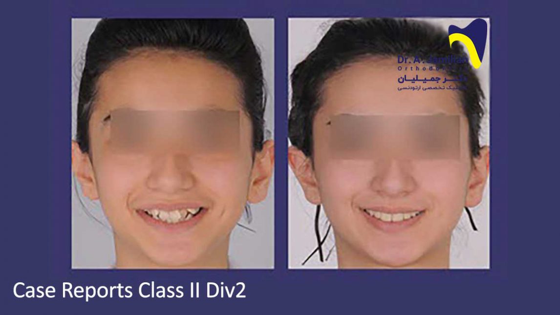 Case Reports-Class II Div 2 - Dr Jamilian