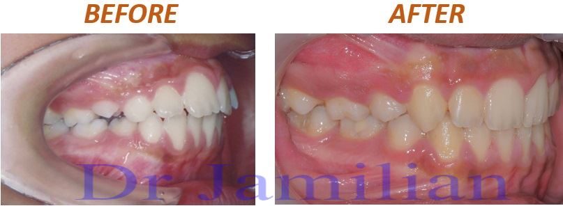 Dr Jamilian Orthodontic Clinic - Class II Division 1