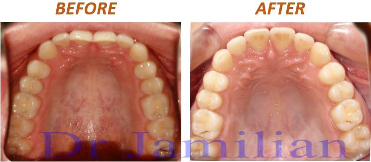 Dr Jamilian Orthodontic Clinic -Case Report-Deep Bite