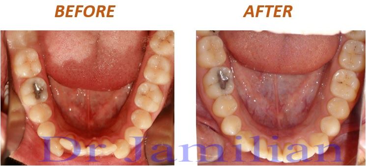 Dr Jamilian Orthodontic Clinic -Case Report-Deep Bite