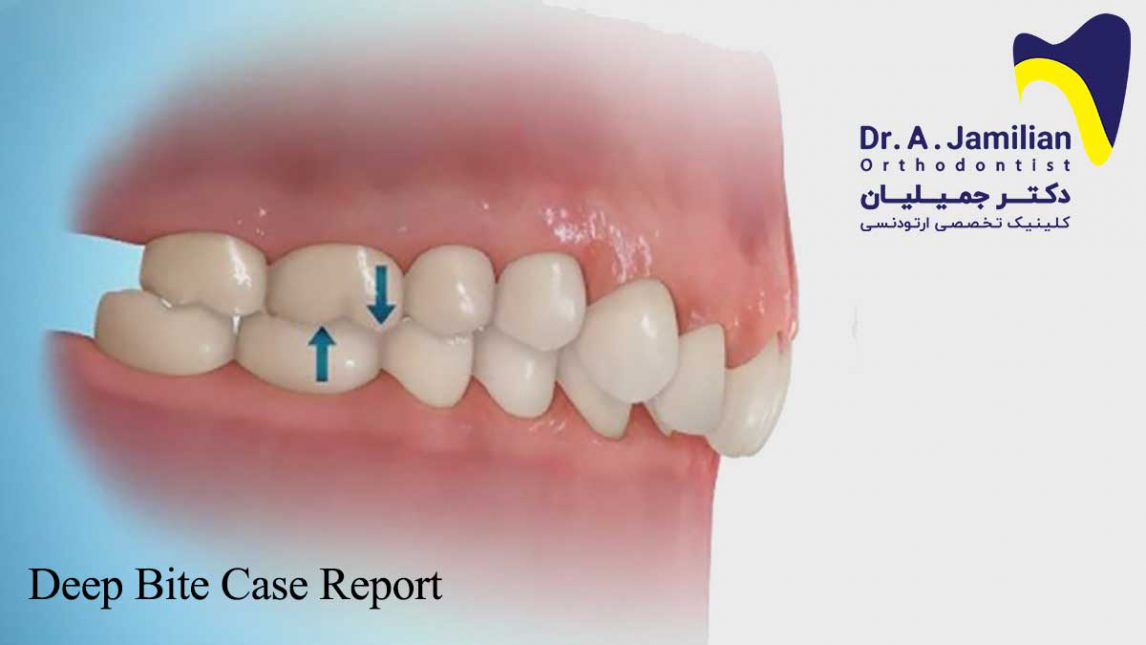 Case Report-Deep Bite - Dr Jamilian