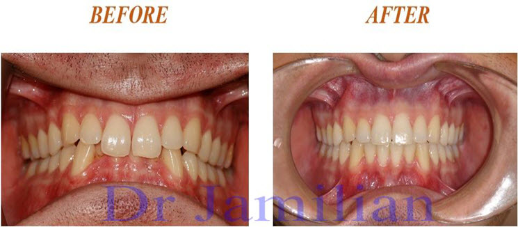 Dr Jamilian Orthodontic Clinic -Case Report-Deep Bite
