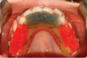 Case Report-Maxillary Deficiency - Dr Jamilian
