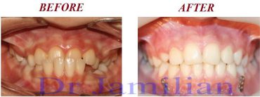 Case Report-Maxillary Deficiency - Dr Jamilian