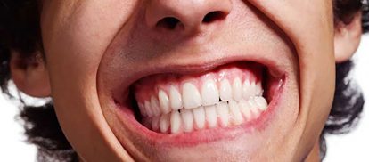 Grinding teeth together - Dr Jamilian