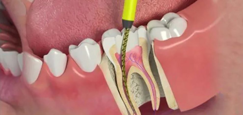Toothache after root canal - Dr Jamilian Toothache after root canal - Dr Jamilian