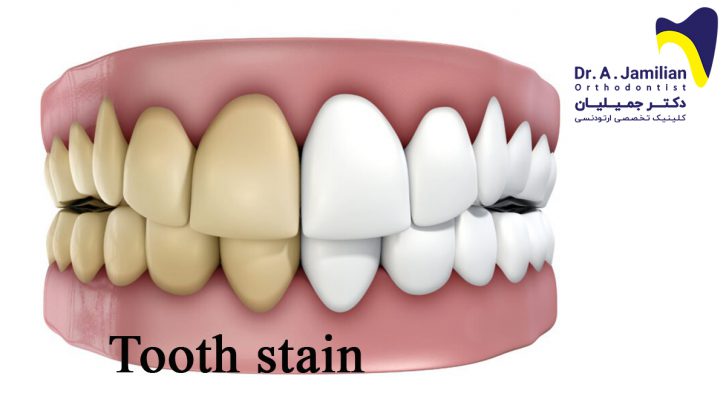 Tooth stain - Dr Jamilian
