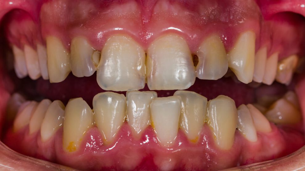 Front tooth decay treatment - Dr Jamilian