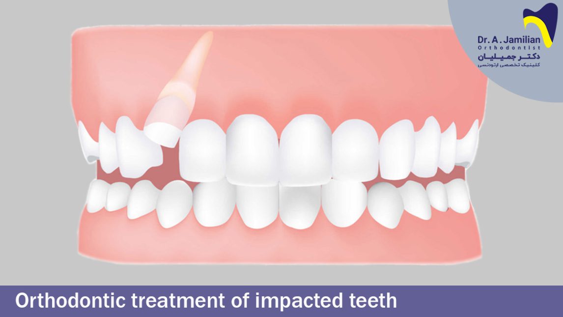 Orthodontic treatment of impacted teeth - Dr Jamilian