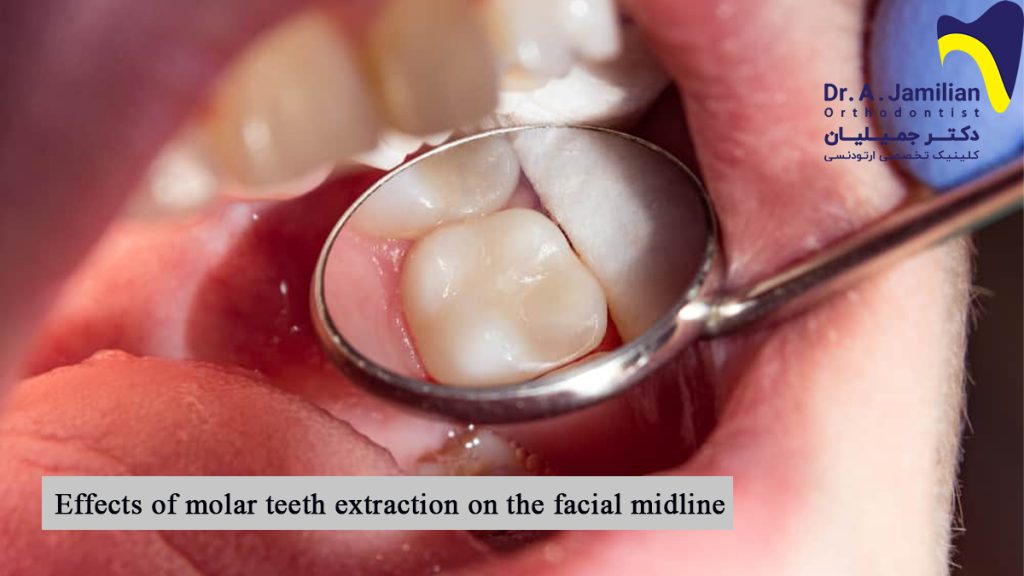 Effects of molar teeth extraction on the facial midline - Dr Jamilian