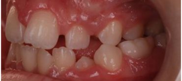 Posterior crossbite orthodontic - Dr Jamilian