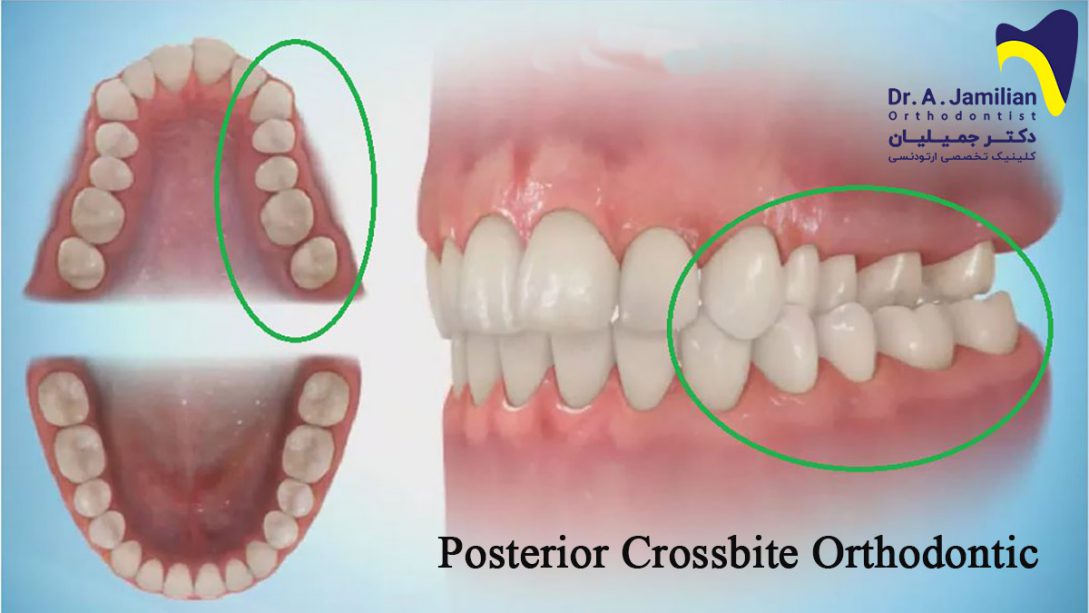 Posterior crossbite orthodontic - Dr Jamilian