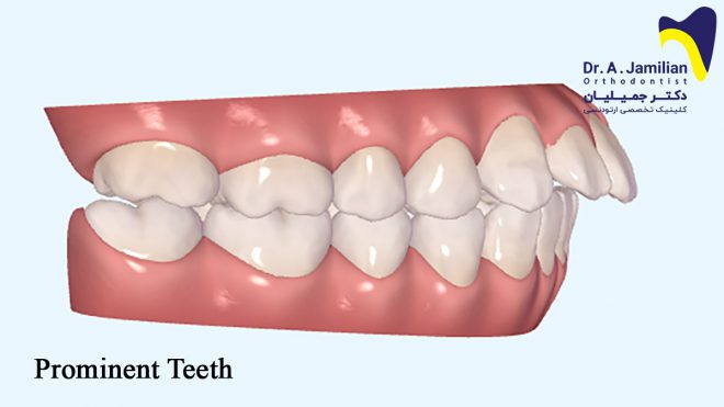 Prominent teeth - Dr Jamilian
