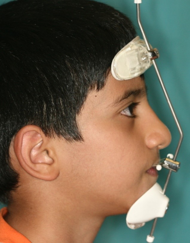 Treatment Protocol For Skeletal Class III Malocclusion In Growing Treatment Protocol For Skeletal Class III Malocclusion In Growing