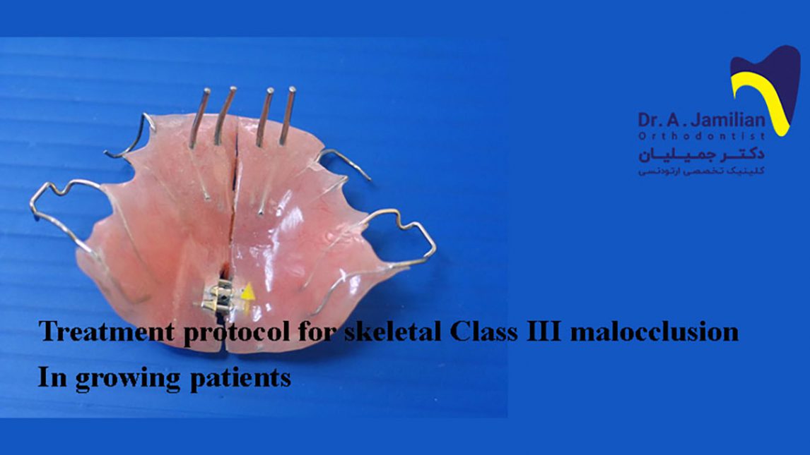 Treatment protocol for skeletal Class III malocclusion in growing ...