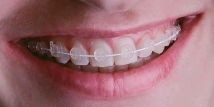 Different Types of Orthodontic Brackets - Dr Jamilian