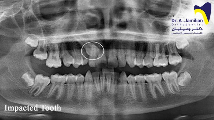 Impacted tooth - Dr Jamilian