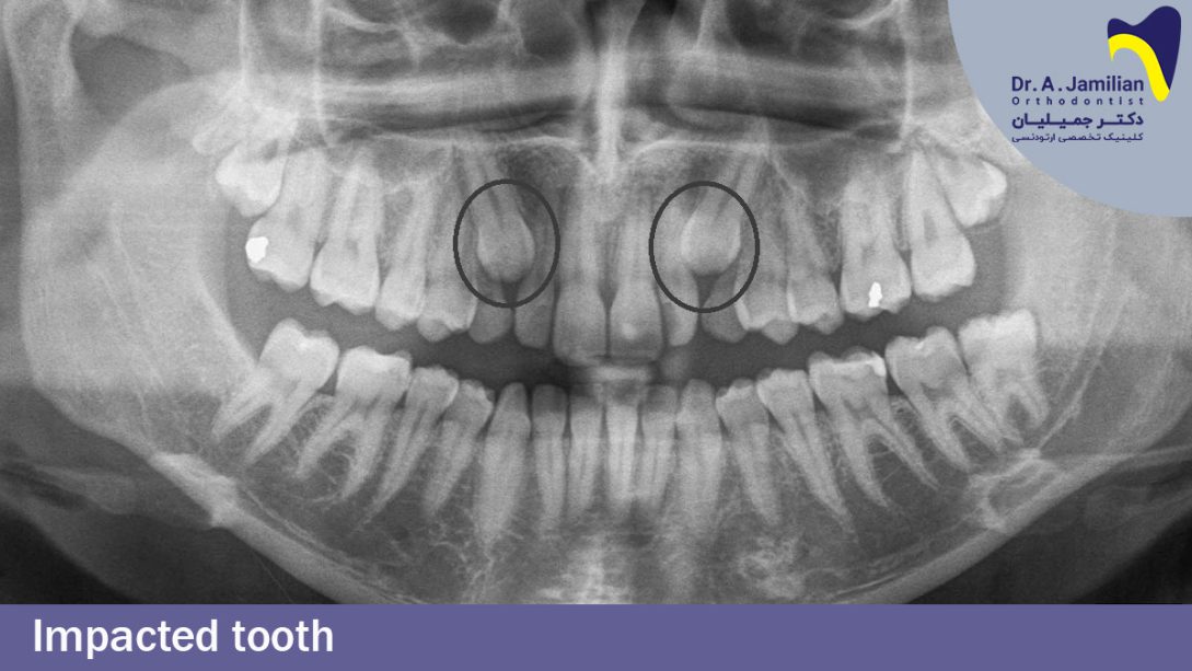 Impacted tooth - Dr Jamilian